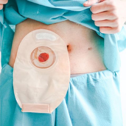 Stoma Care | Dynamic Homecare Services